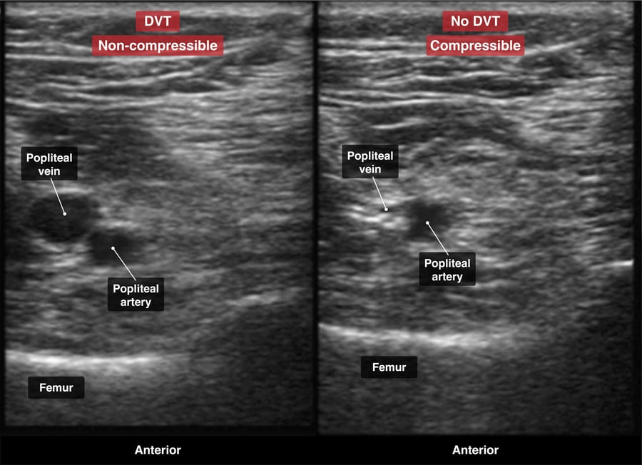 POCUS - Question - Rosh Review POCUS - Question - Rosh Review